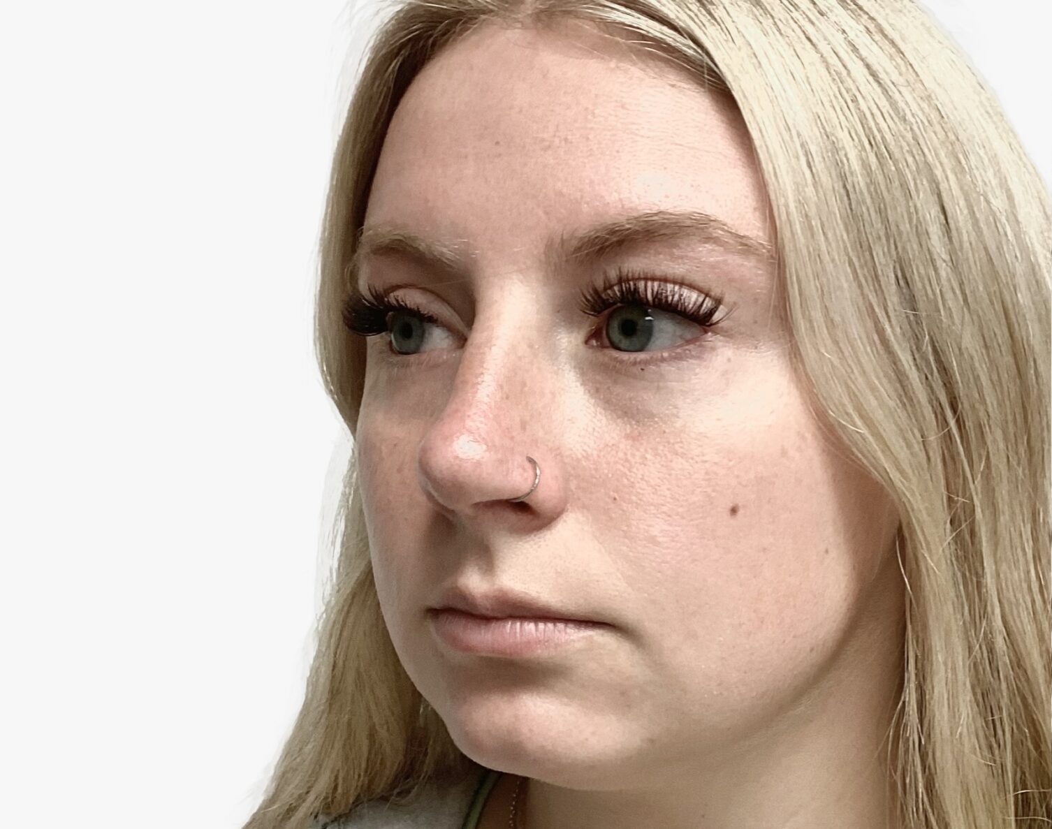 Rhinoplasty - Dr. Biskup