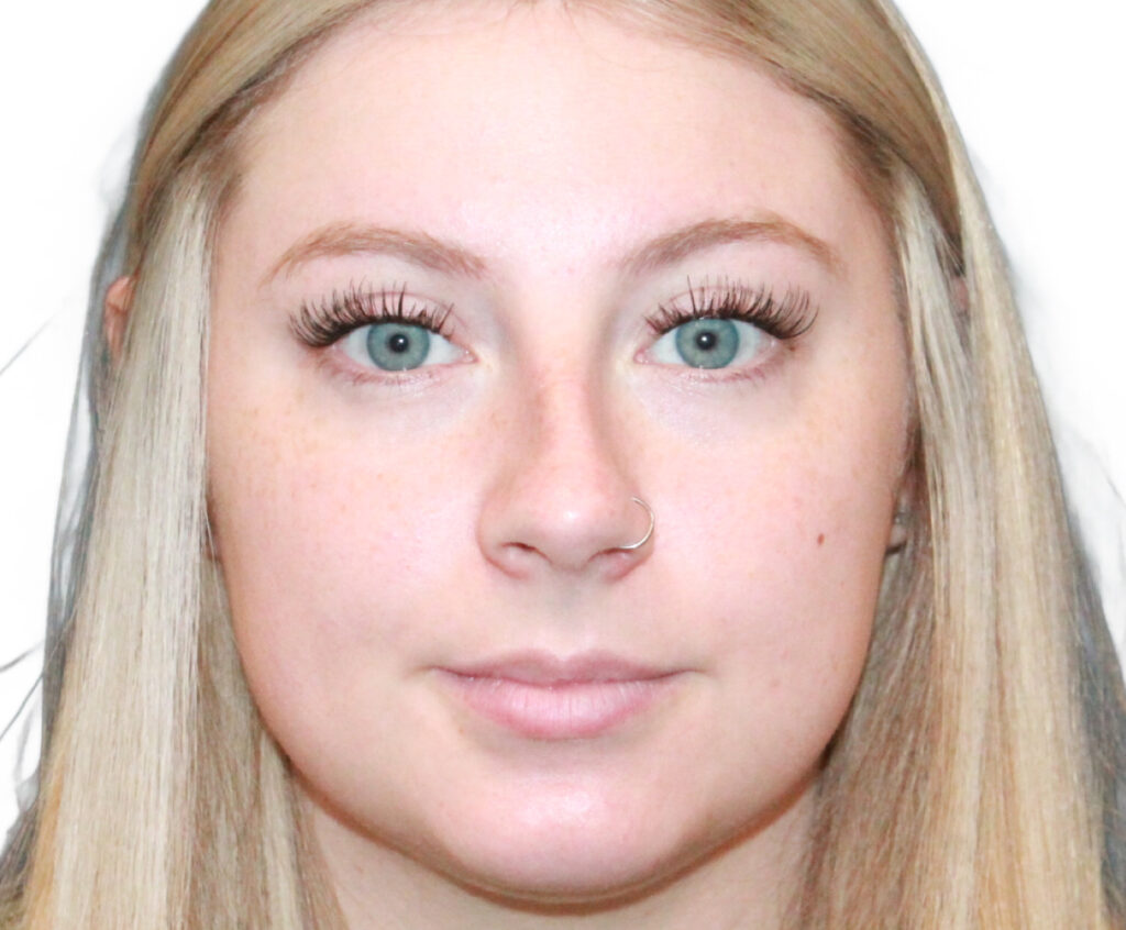 Rhinoplasty - Dr. Biskup