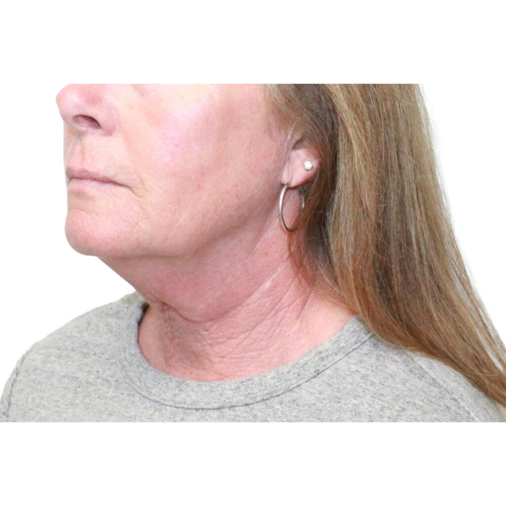 Neck Lift - Dr. Biskup