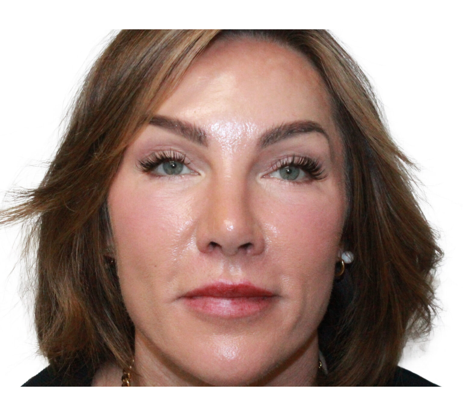 Quad Blepharoplasty & Finesse Rhinoplasty - Dr. Biskup