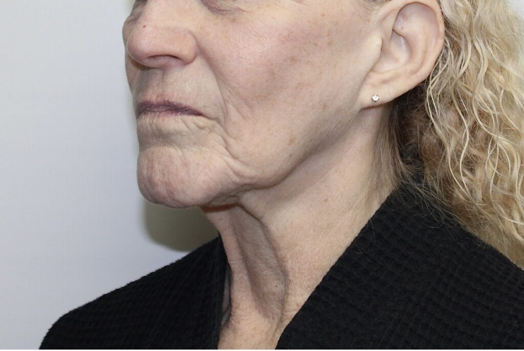 Facelift - Dr. Biskup