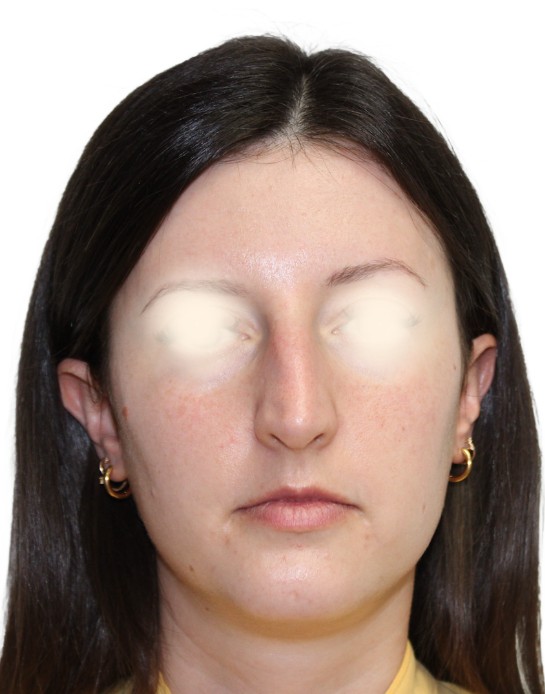 Rhinoplasty - Dr. Biskup